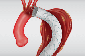 Aortic Intervention | Cook Medical