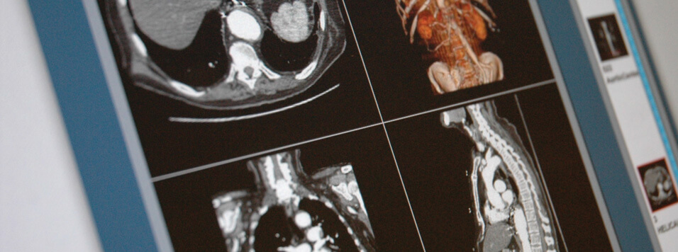 Aortic Intervention | Cook Medical