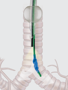 Endobronchial blockers for one-lung ventilation | Critical Care