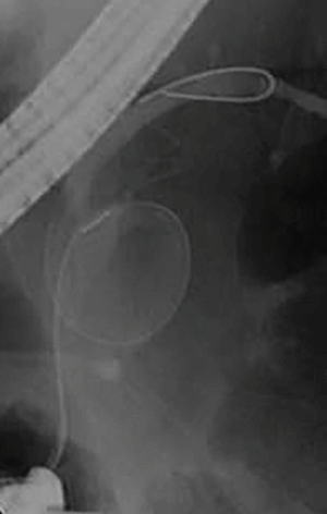 The Acrobat 2 Calibrated Tip Wire Guide | Endoscopy