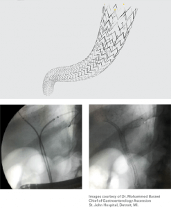 Cook adds to their ever-expanding portfolio of biliary stents | Endoscopy