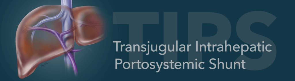Educational video series: TIPS procedures | Cook Medical
