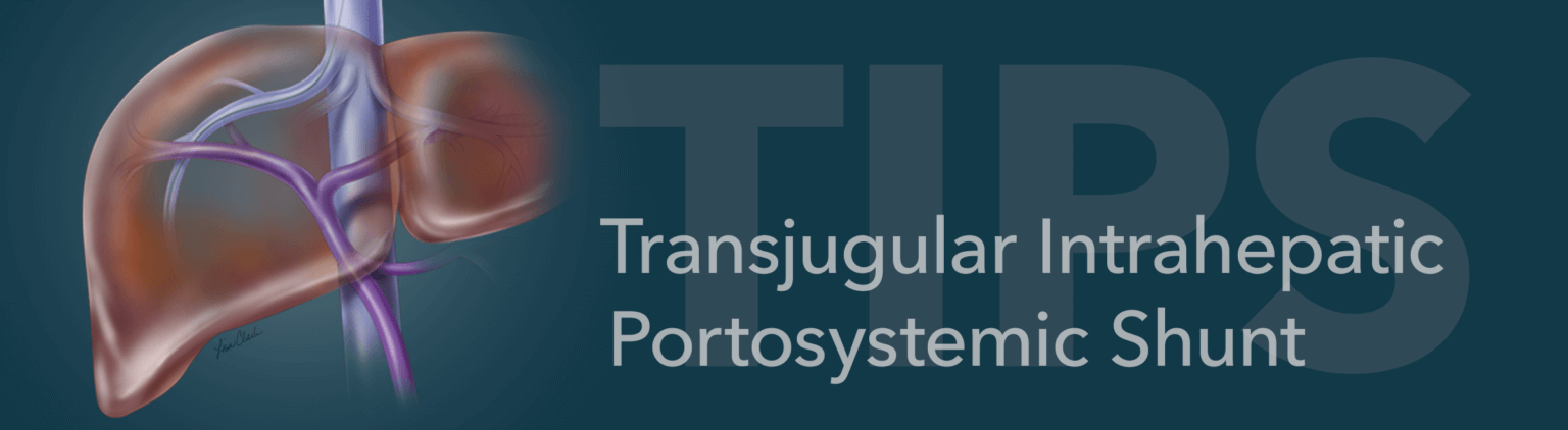 Educational video series: TIPS procedures | Cook Medical